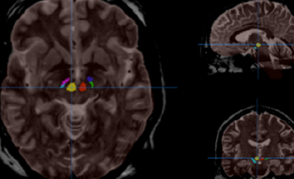 VOLBRAIN : Software to analyze mMRI brain data. It provides a report including volume ...