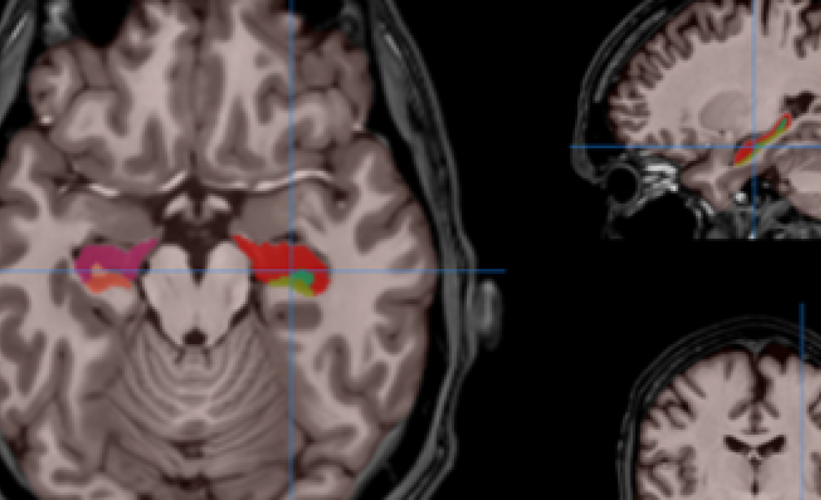 VOLBRAIN : Software to analyze mMRI brain data. It provides a report ...