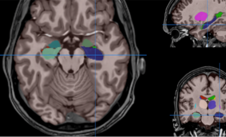 VOLBRAIN : Software to analyze mMRI brain data. It provides a report ...