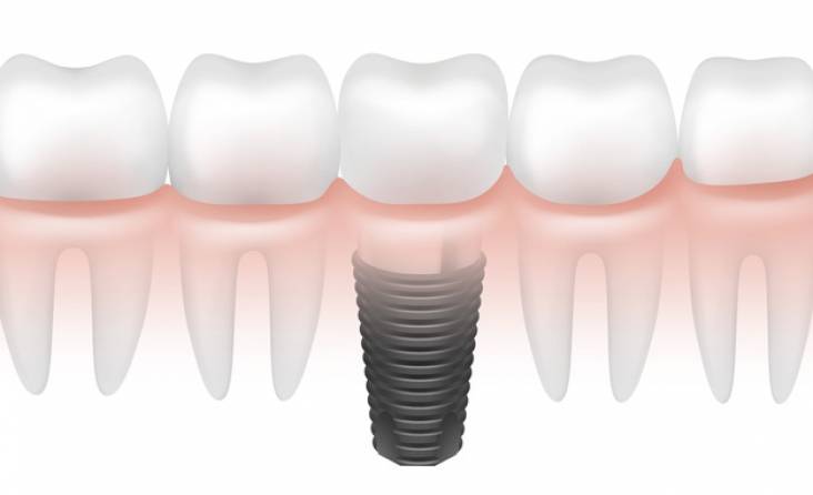 BIOACTIM: BIOACTIVE TOOTH IMPLANT - Innovative bone implant connection