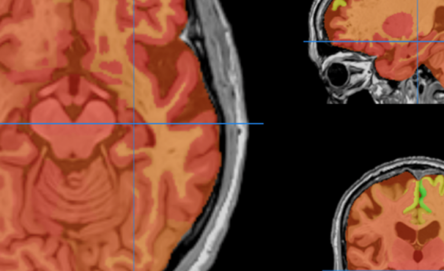 CERES : Software to automatically analyze the cerebellum in brain MRI ...