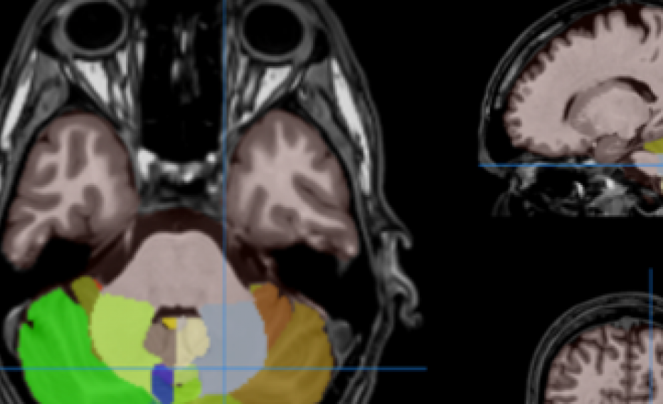 VOLBRAIN : Software to analyze mMRI brain data. It provides a report including volume ...