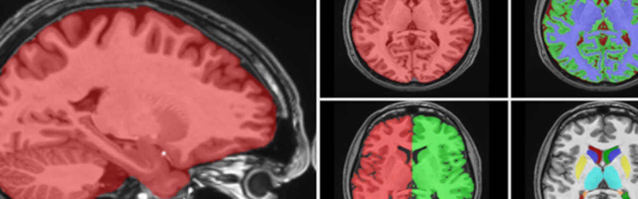 VOLBRAIN : Automated MRI brain volumetry system