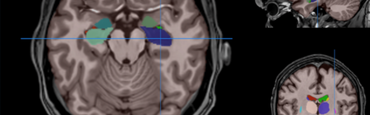 VOLBRAIN : Software to analyze mMRI brain data. It provides a report including volume ...