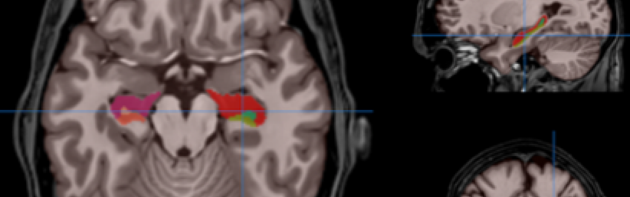 HIPS : Software providing hippocampus subfield segmentation based on ...